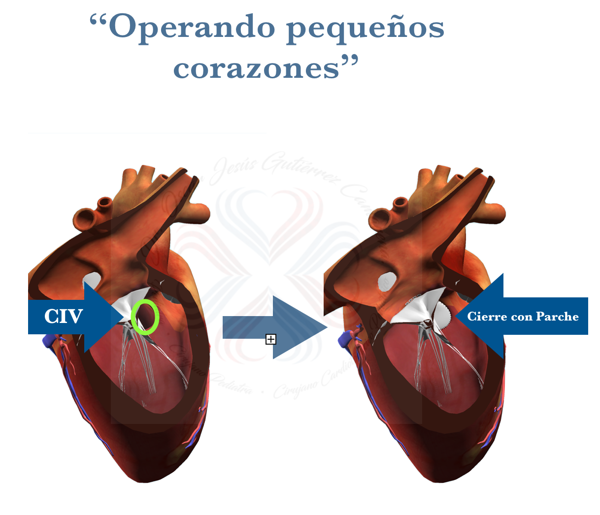 Comunicación Interventricular – CIRUGIA DE CORAZON PEDIATRICA
