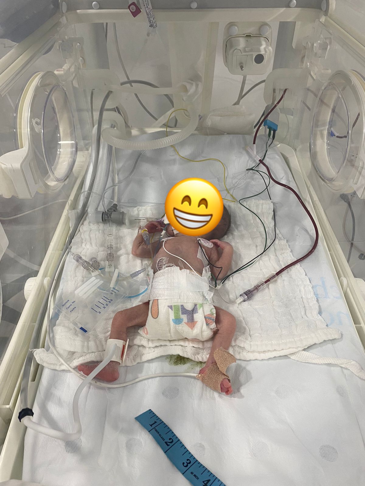 Paciente de 560 gramos de peso, cirugía exitosa – CIRUGIA DE CORAZON ...